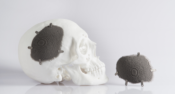 3D Printing and Customised Medical Implants | Protolabs